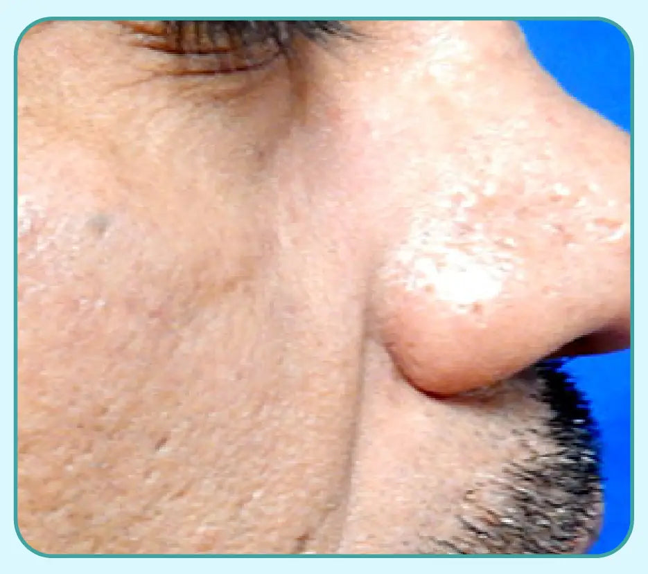 REMOVEDOR DE VERRUGAS WART REMOVER [PV1-META] – Quetzal Salud®